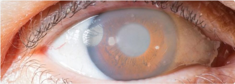 Glaucoma Treatment & Advanced Eye Care In Halifax