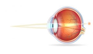 Hyperopia - King Cross Opticians